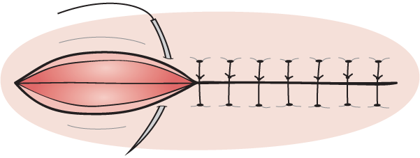 Suturing Techniques: Simple Interrupted Technique - NP Skills Made Easy